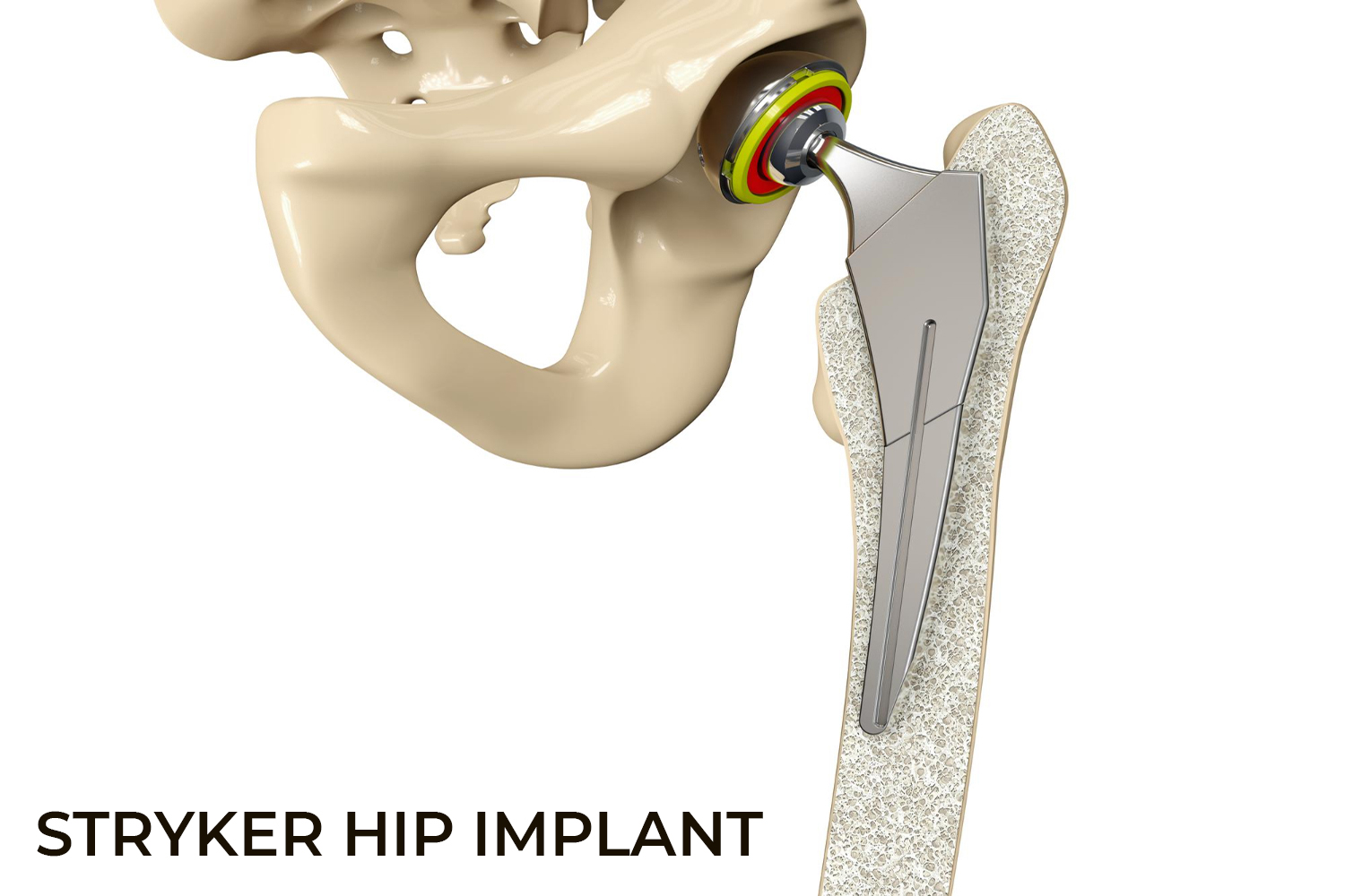 Stryker Hip Implant | Neural IT